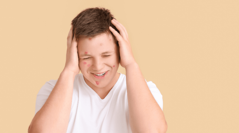 Subclinical Acne: What Is It and How Do You Treat It? - Groom Journal